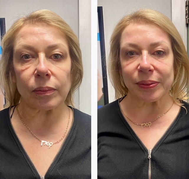 Bristol's HIFU non-surgical facial lift - Beauty Box