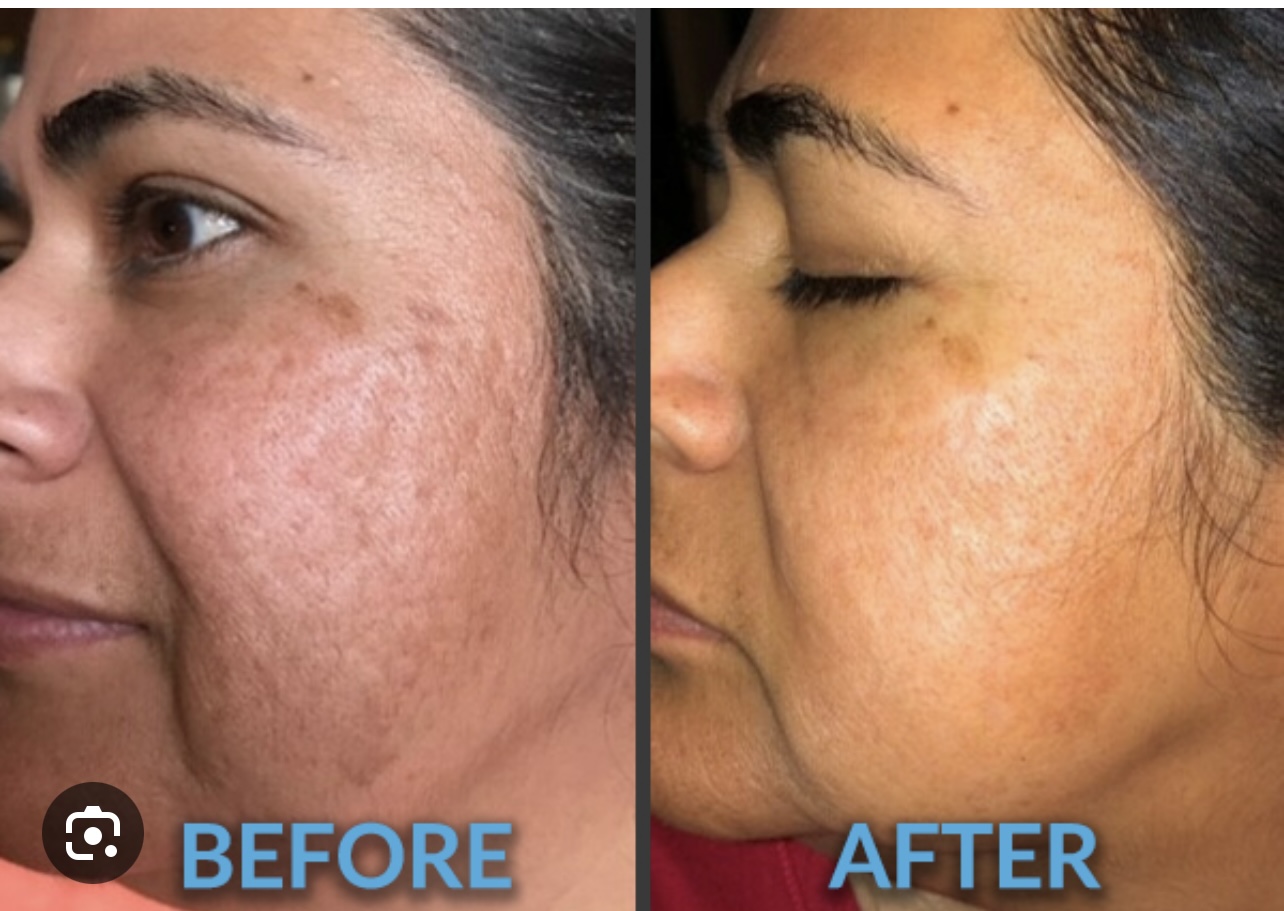 Radio Frequency Microneedling by Lynton (Focus Dual) - Beauty Box