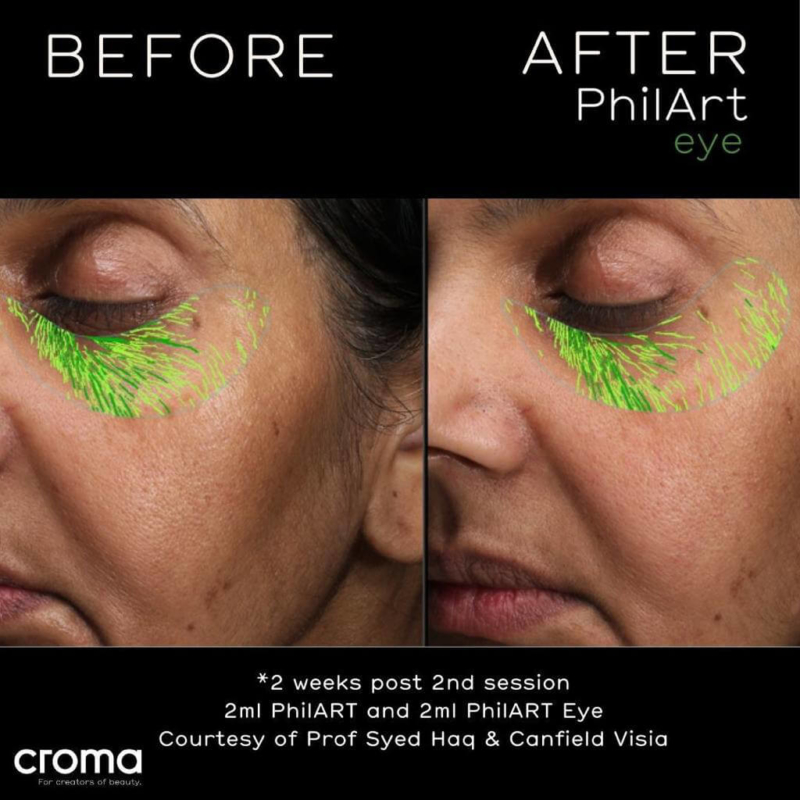 Profhilo and Seventy Hyal skin boosters and Lumi Eyes (available in ...
